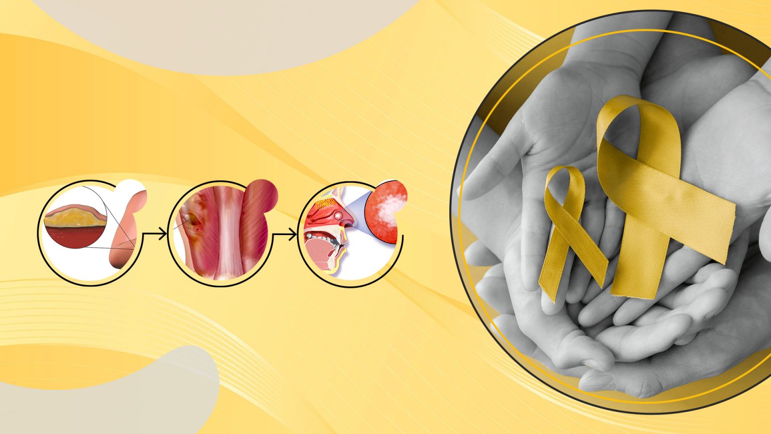 All you need to know about Sarcoma- the rare Cancer - Body Revival