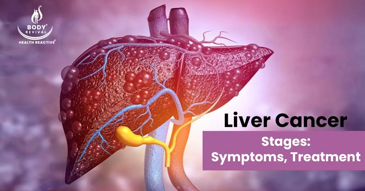 Liver Cancer Stages: Symptoms, Treatment Options - Body Revival